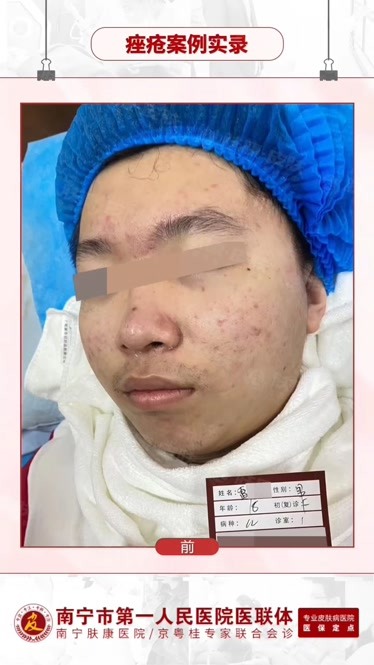 南宁肤康皮肤专院-痤疮和痘痘一样吗-南宁皮肤科能看痘痘