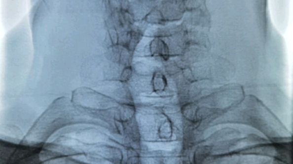 吴春根介入案例61 颈椎网袋辅助经皮椎体成形术