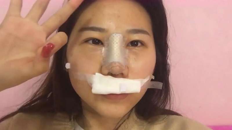小姐姐分享隆鼻手术的术后恢复视频,看完后表示为了美也是蛮拼的
