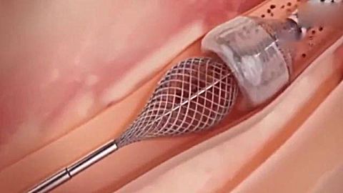 【来自知乎】动画演示10种疏通人体血管的方法。