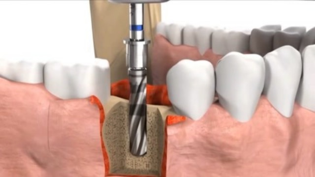 知道怎么种植新牙吗?3D动画模拟展示,看电钻钻孔,说不出的过瘾