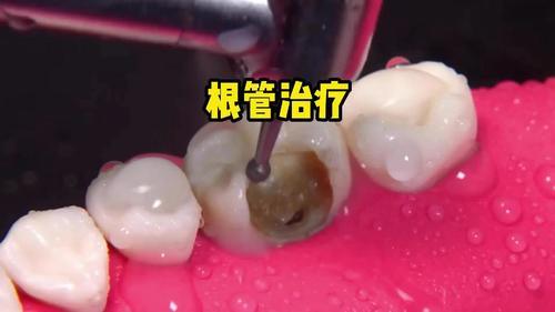 你知道根管治疗有多酸爽吗?