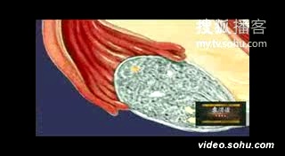 输卵管堵塞会导致不排卵吗