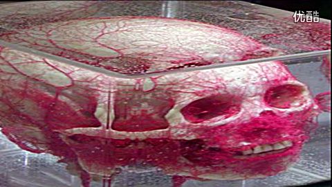 兴城绿色起点疗养院——3D血栓症—栓塞和脑血栓动画