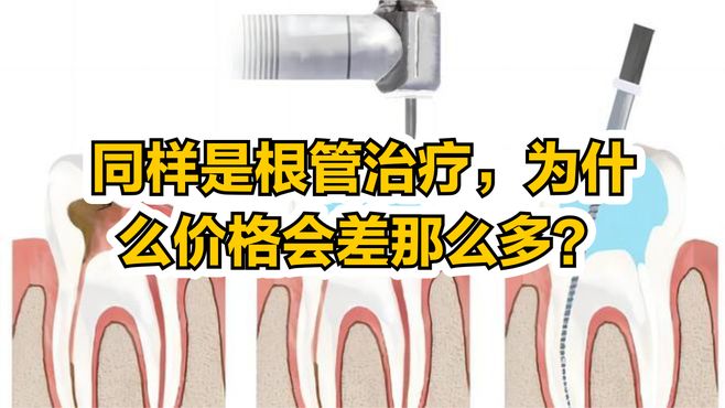 同样是根管治疗,为什么价格会差那么多?