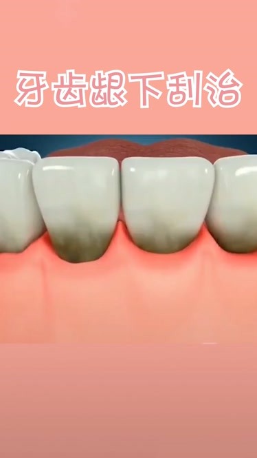 牙齿龈下刮治什么意思 什么情况需要牙龈下刮治