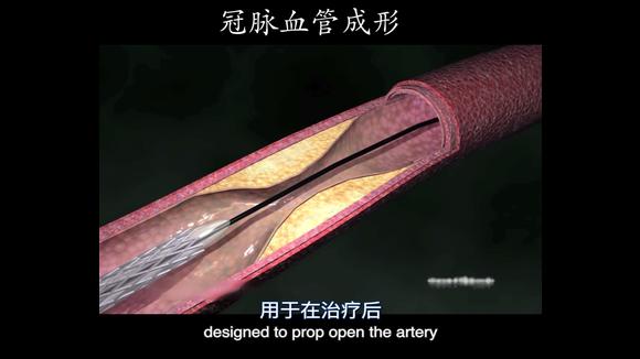 动画演示-冠脉成形-支架植入