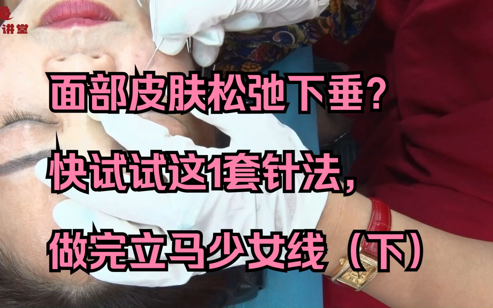 面部皮肤松弛下垂?快试试这1套针法,做完立马少女线(下)