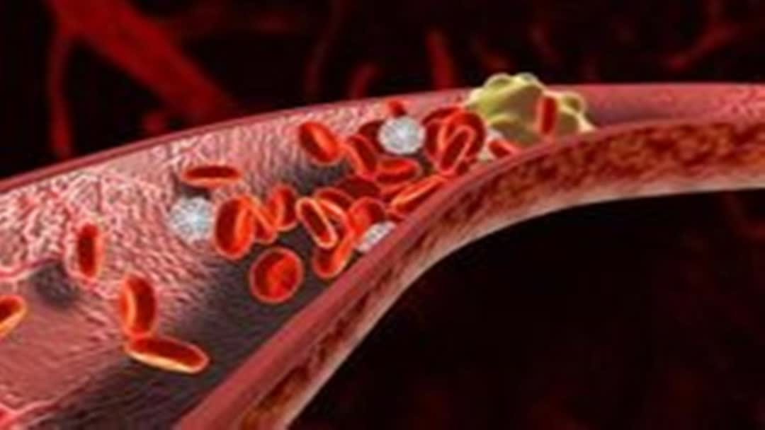 如果血管堵了,身体会有这4种症状,要警惕血栓,赶紧去医院!