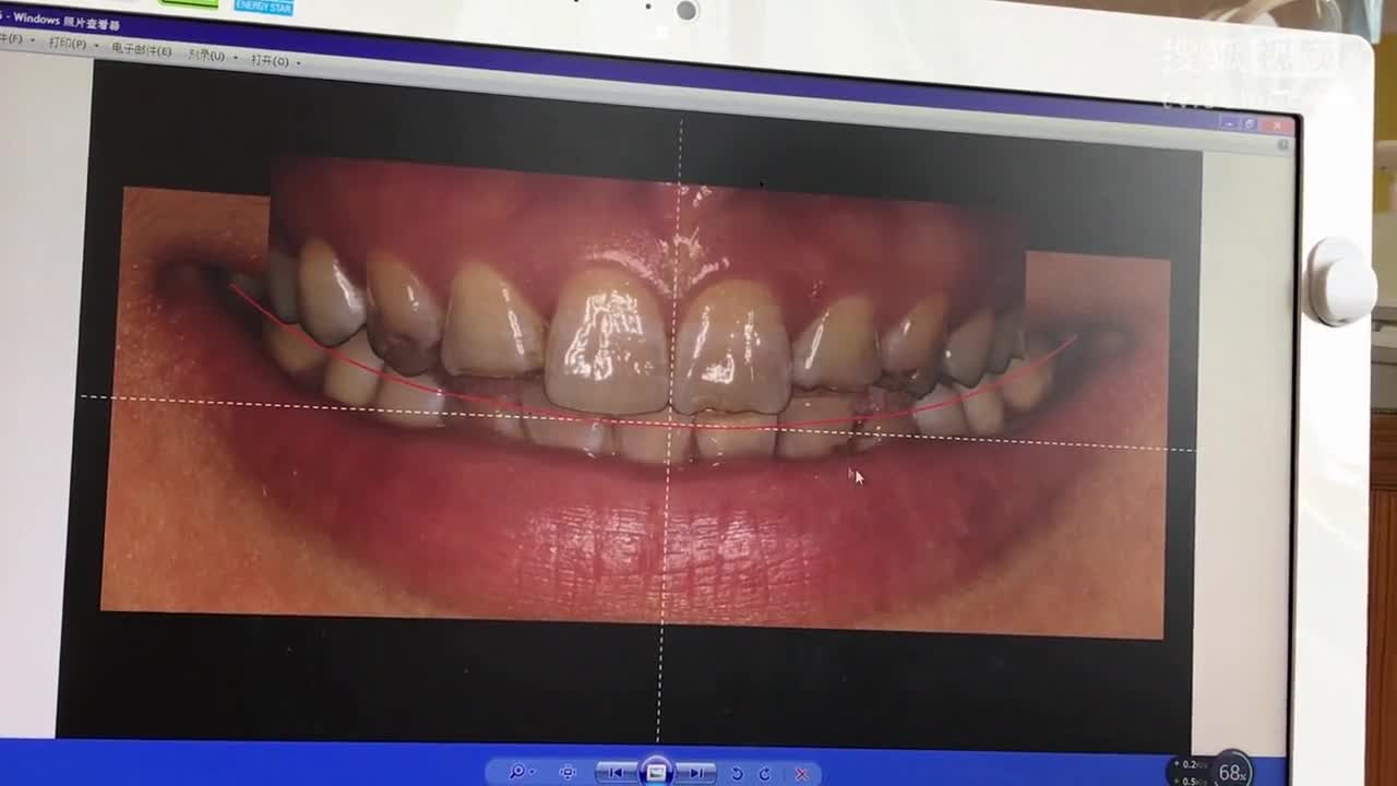 【知识讲堂】DSD微笑设计:还你一口美丽牙齿