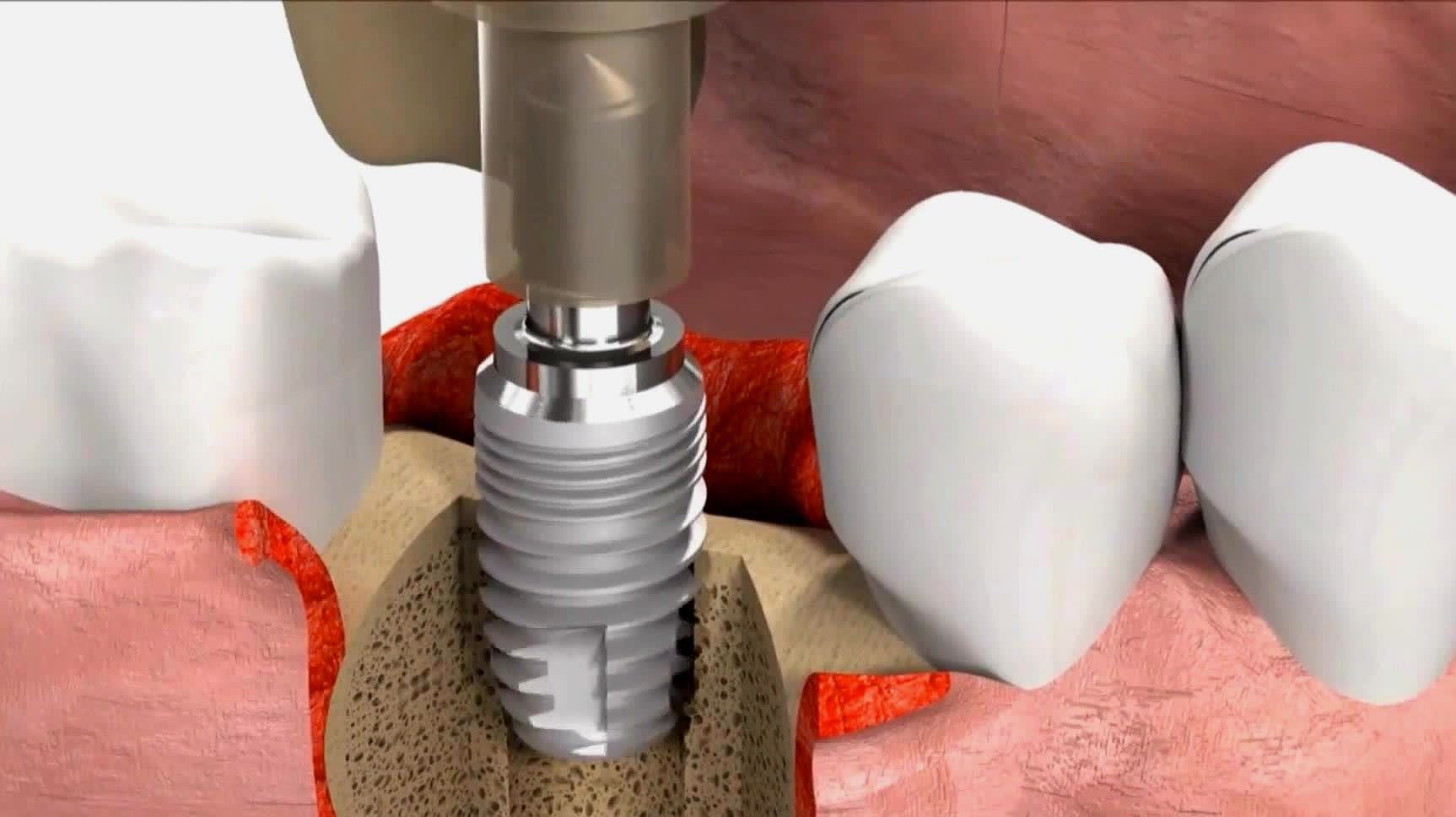 3D演示种牙全过程!又是打孔又是拧螺丝,网友:隔着屏幕都害怕!