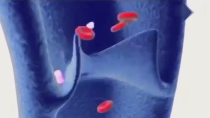 羊水栓塞是什么?