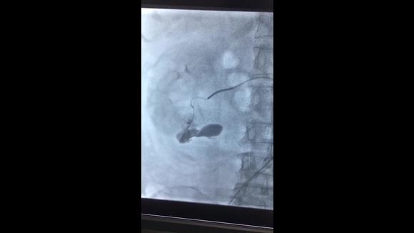 肾动脉分支造影破裂出血,应该立即栓塞止血!