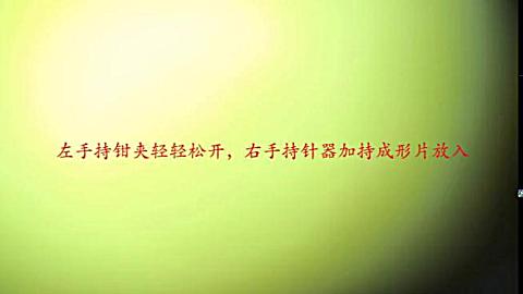下颌7号牙齿远中龋坏假壁恢复上橡皮障的方法