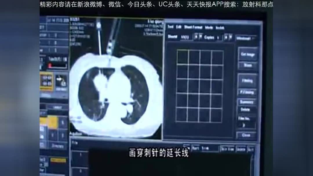 医学科普短片:CT定位穿刺活检操作演示