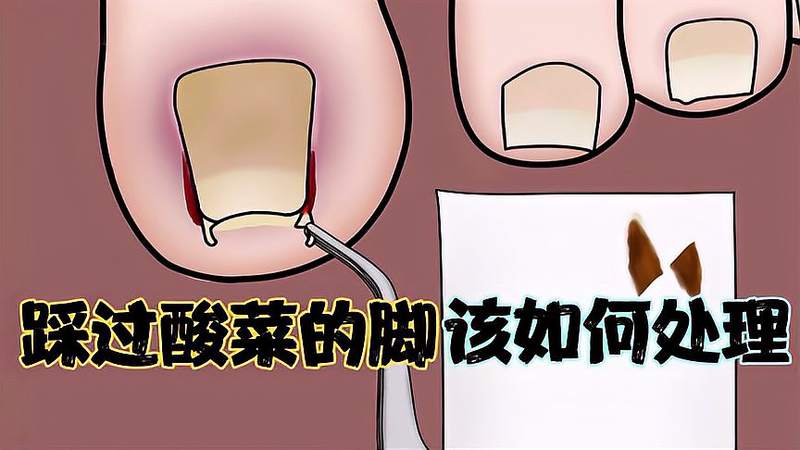 这脚你见过吗?超逼真沉浸式修脚全过程!(剧情需要 请勿模仿)