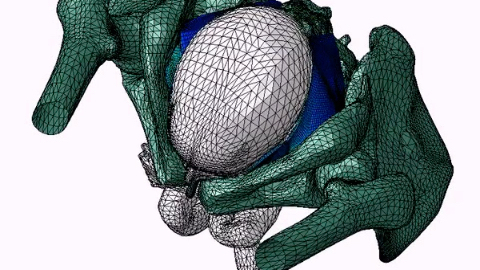 Abaqus模拟仿真分析女性怀孕分娩,为难产孕妇找到最佳治疗方案。