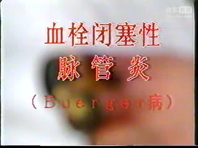 184-血栓闭塞性脉管炎_1