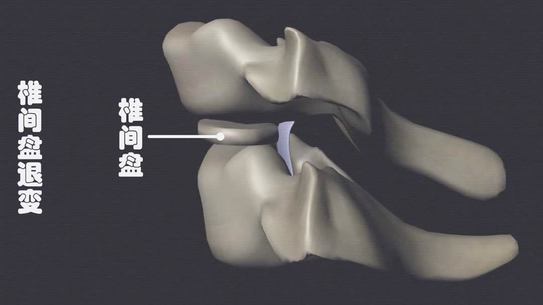 颈椎病会导致背痛吗?牵引、按摩能不能治颈椎病?吃什么药缓解?