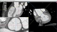 RadiAnt DICOM Viewer - 3D MPR