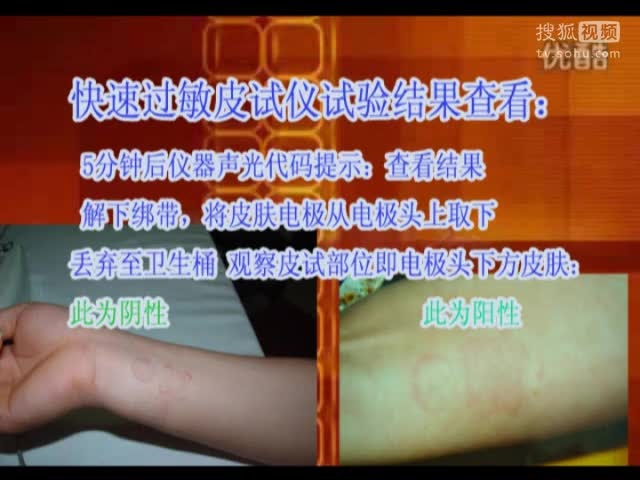 皮内注射技术无痛皮试仪试验法