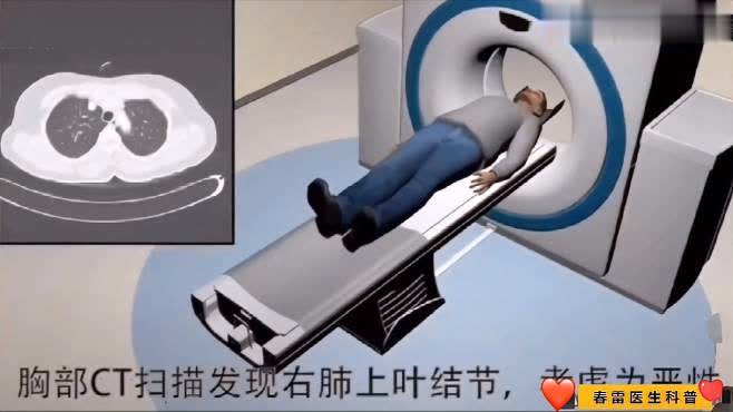 肺结微创手术全过程