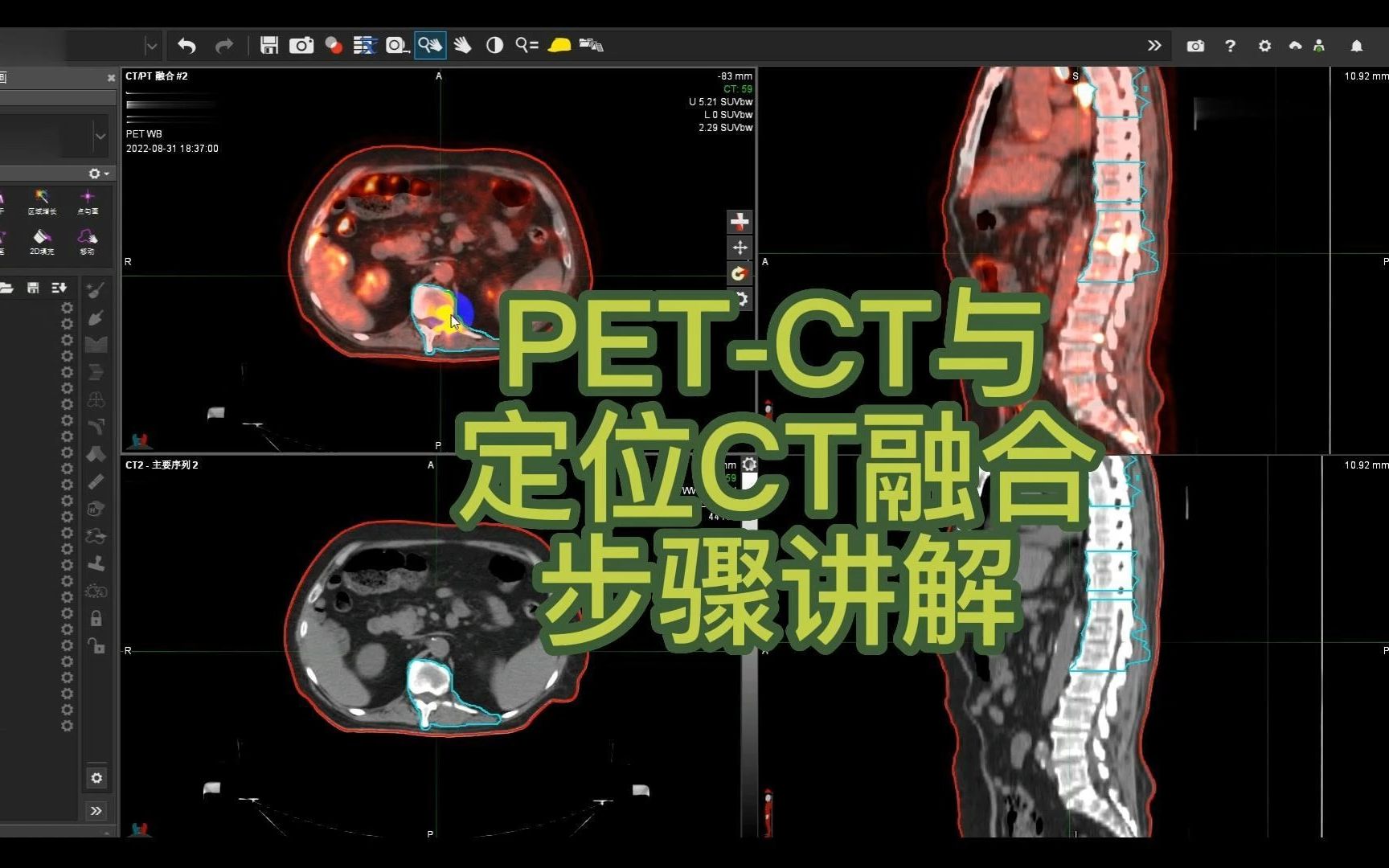 PET-CT与定位CT融合步骤--便于放疗靶区勾画
