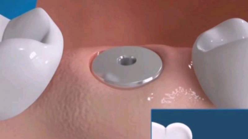 牙齿健康种牙前了解一下种植牙过程