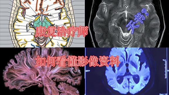 精准康复-定位诊断:脑部CT和MR的快速解读1