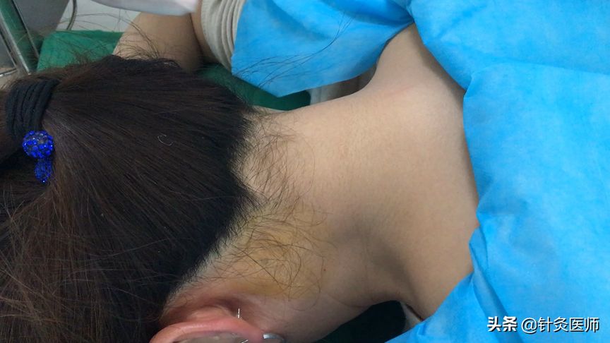 安眠穴的穴位埋线