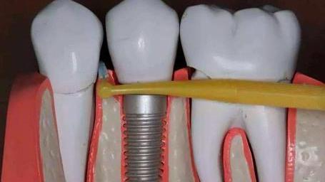 253D动画演示"种牙齿"全过程,隔着屏幕都疼,庆幸自己牙齿完整