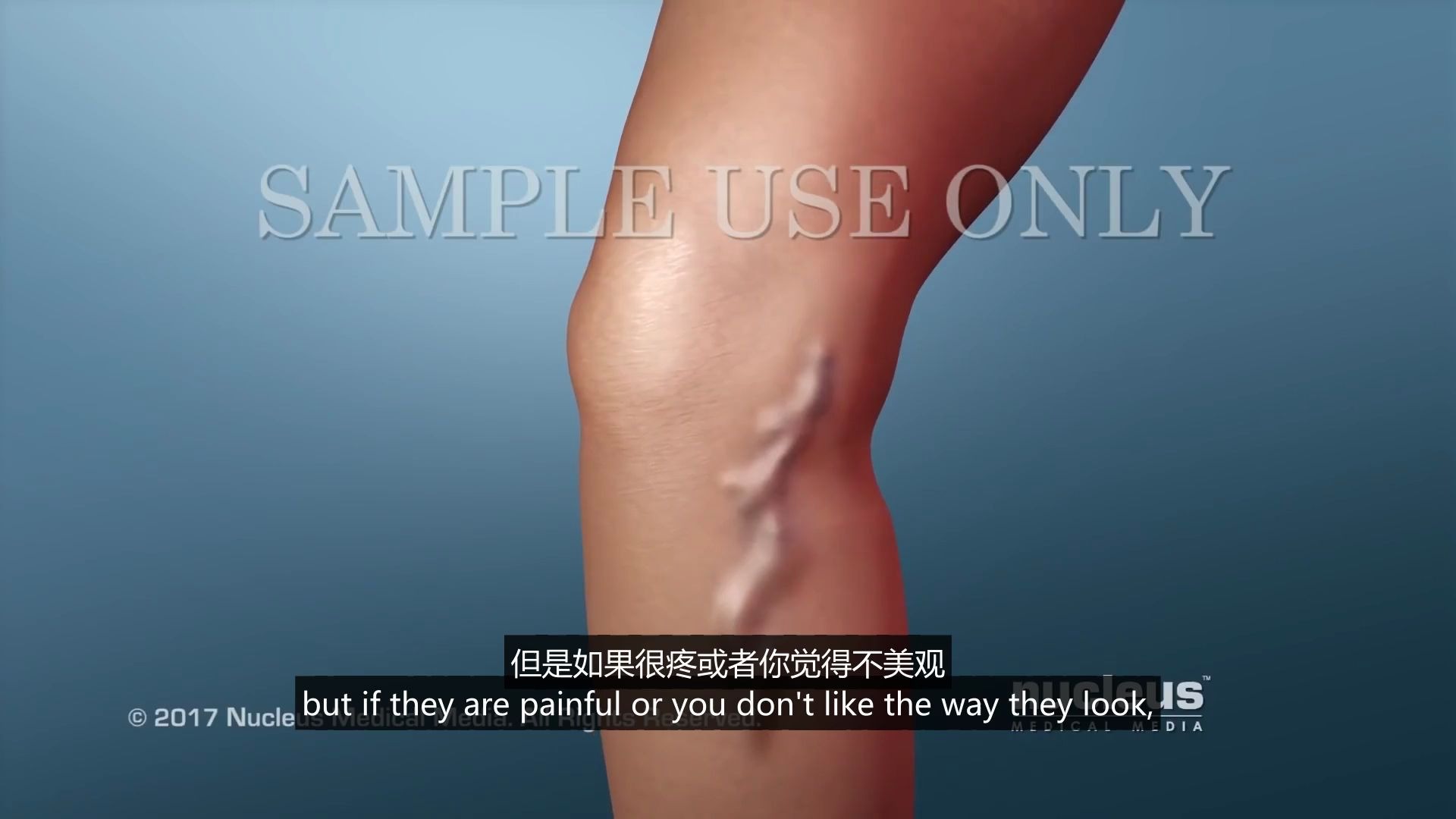 【科普】--静脉曲张可能引起血栓?这个视频告诉你怎么治疗。