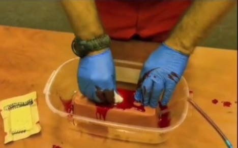 “穿孔伤”如何用绷带止血