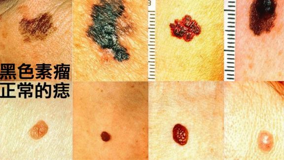 痣具有癌变风险,哪些特征的痣需要去除?介绍一下