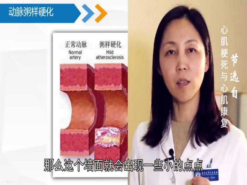动脉粥样硬化是怎么形成的