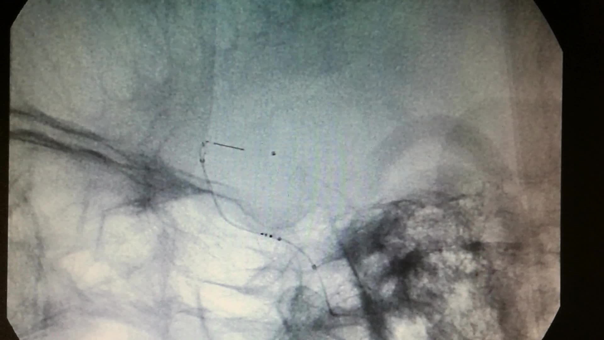 Livs支架释放录像
