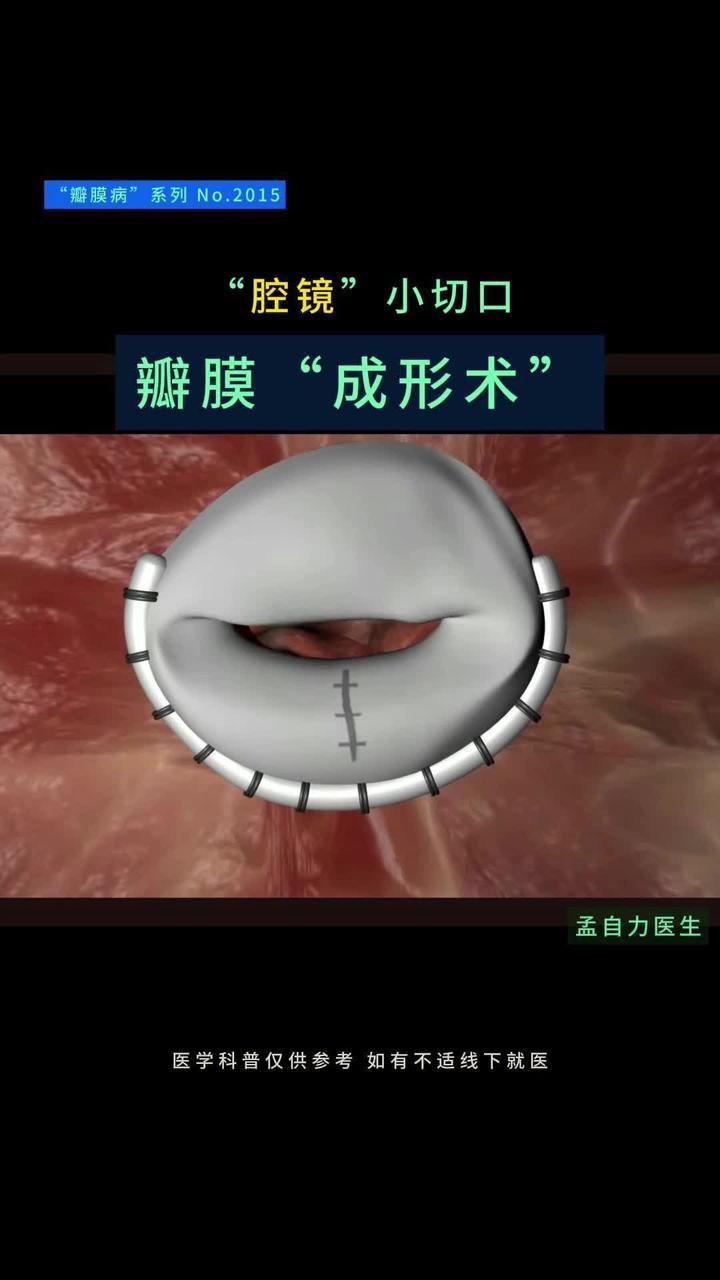 "腔镜"小切口 心脏瓣膜"成形术" #心脏瓣膜 #心瓣膜病 #瓣膜病 #微创...