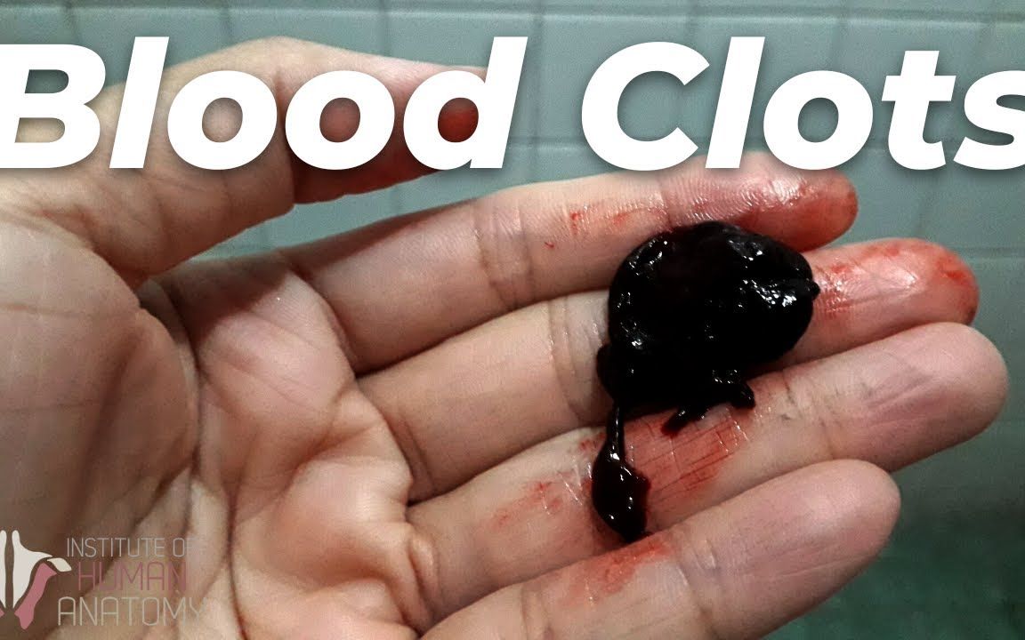 致命的血栓 | 大体老师来了 | 双语字幕