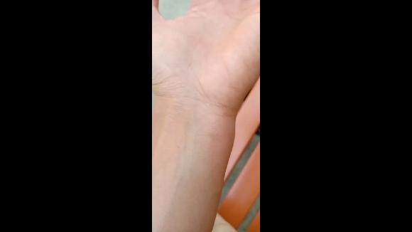 【结核皮试】有一圈7毫米以上的红晕，你看的出来吗？