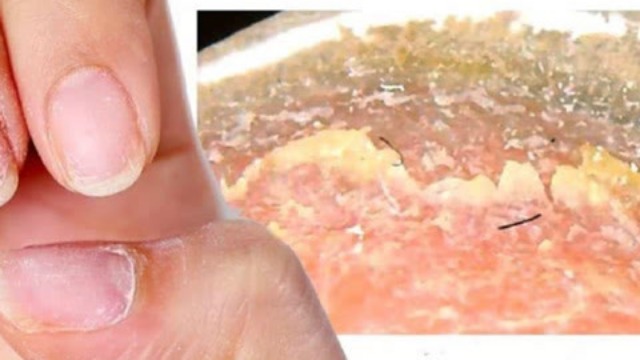 手指甲上的细菌到底有多少?显微镜放大100倍,你还敢...