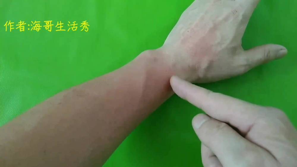 天气炎热,晒伤了怎么办?我有几个方法,挺实用的