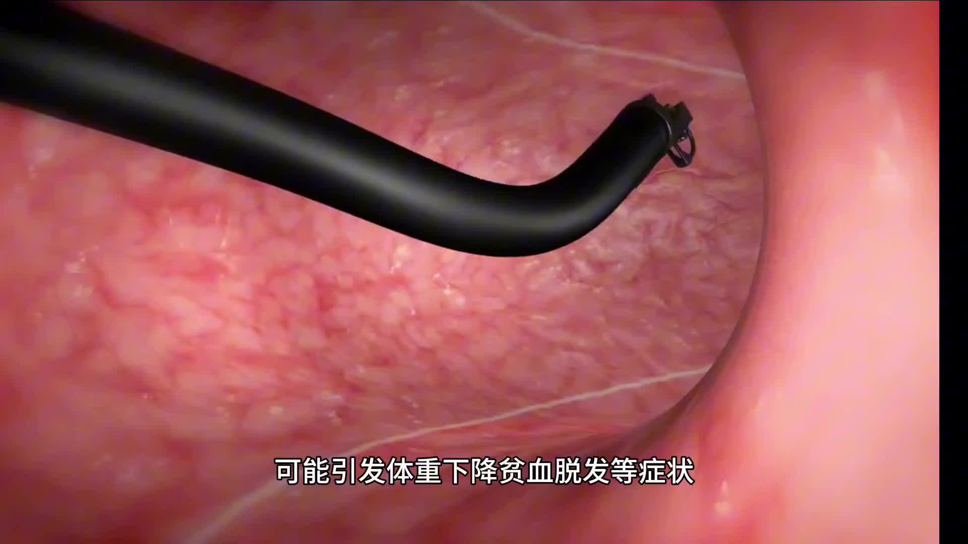 不开刀减肥手术过程,胃镜下胃折叠手术,3D演示。#科普新知自习室