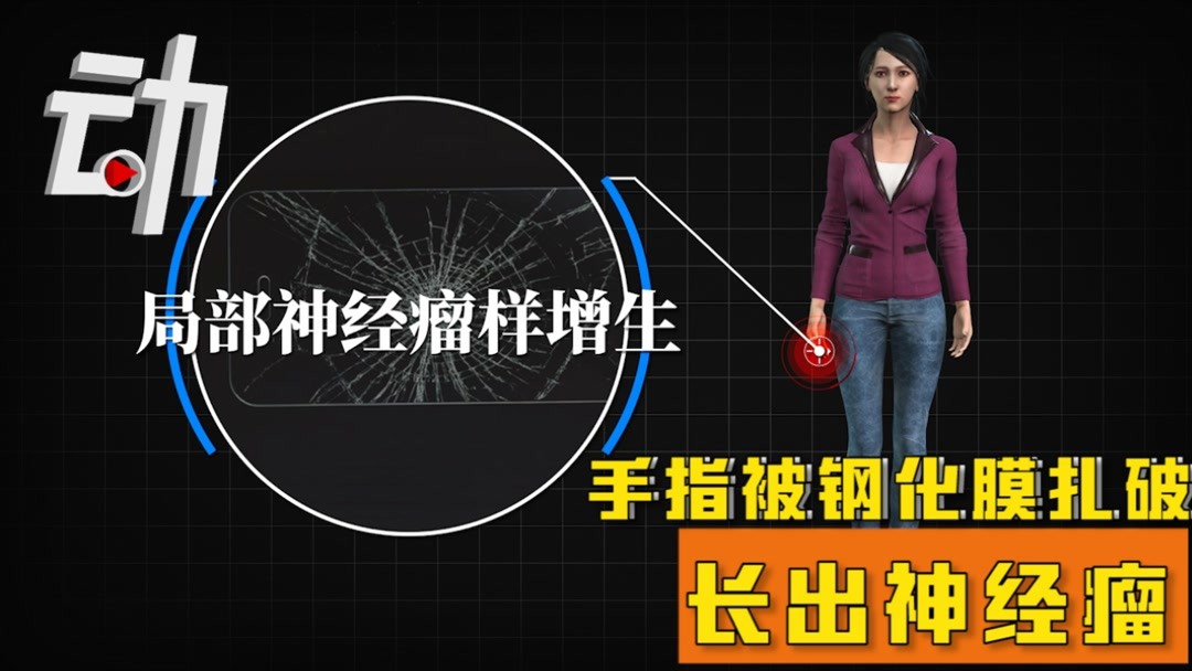 手指被钢化膜扎破长出神经瘤:手术后发现毫米级碎片