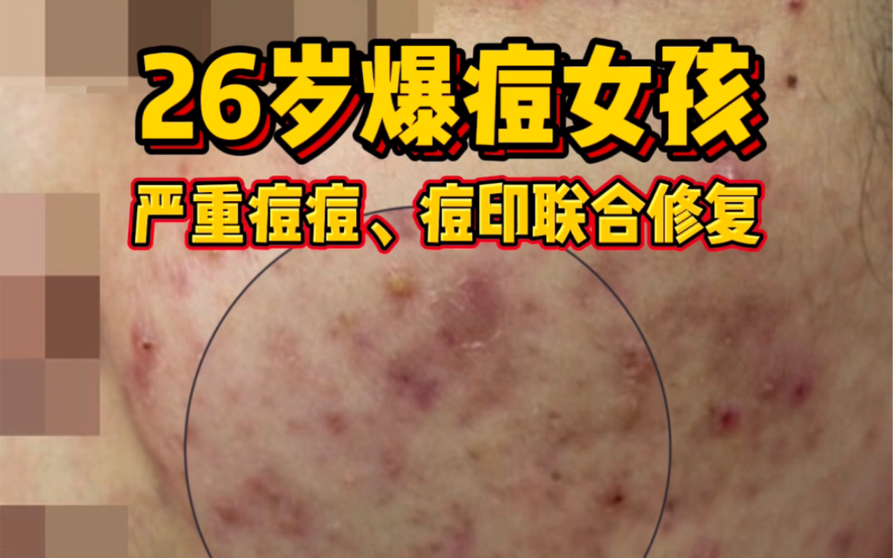 严重痘痘➕痘印 做了黄金微针联合治疗后的皮肤对比