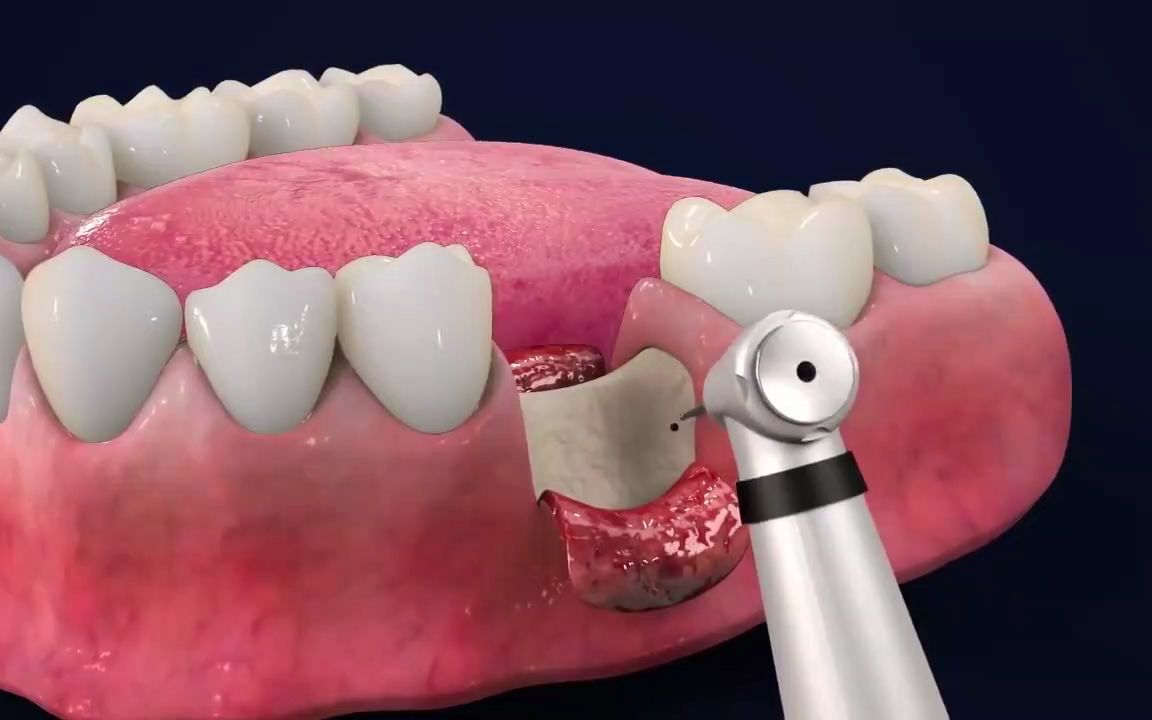 (3D 牙科动画)如何进行种植牙