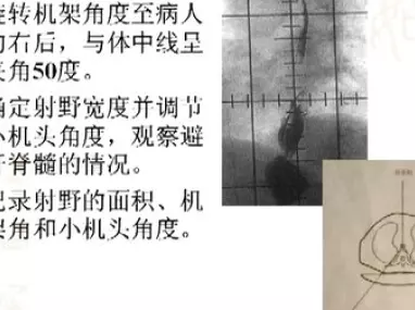 常见肿瘤的模拟定位技术1