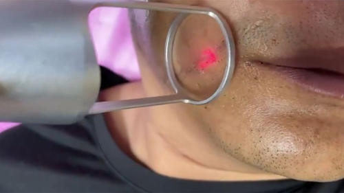 外伤性的疤痕,可以通过激光的方式治疗