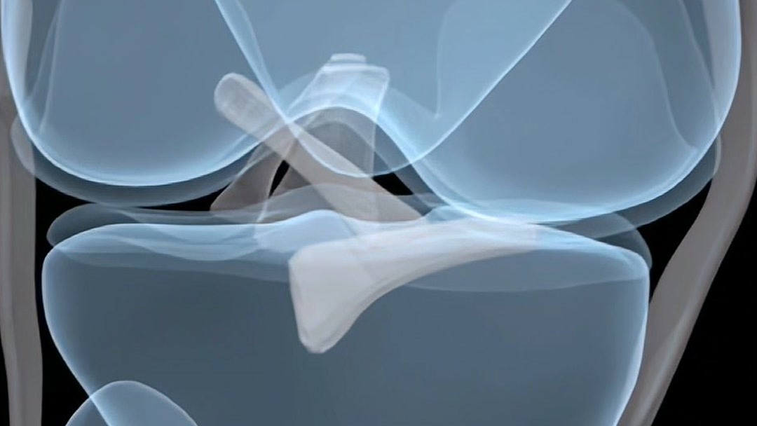 肘关节尺桡骨内固定失败重新术