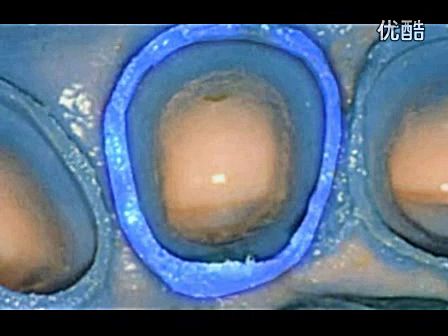 牙体预备、印模制取 茄子口腔云提供_0