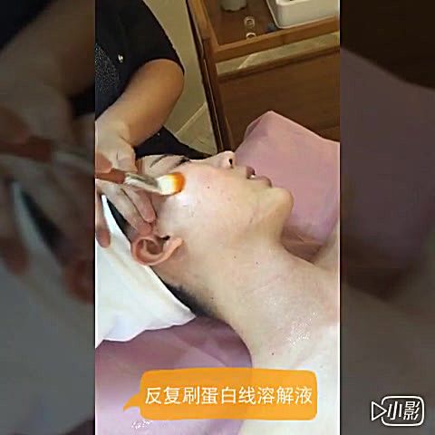 无针埋线操作视频